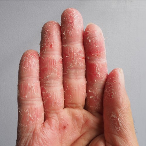 How to Get Rid of Eczema Itching | Health and Care