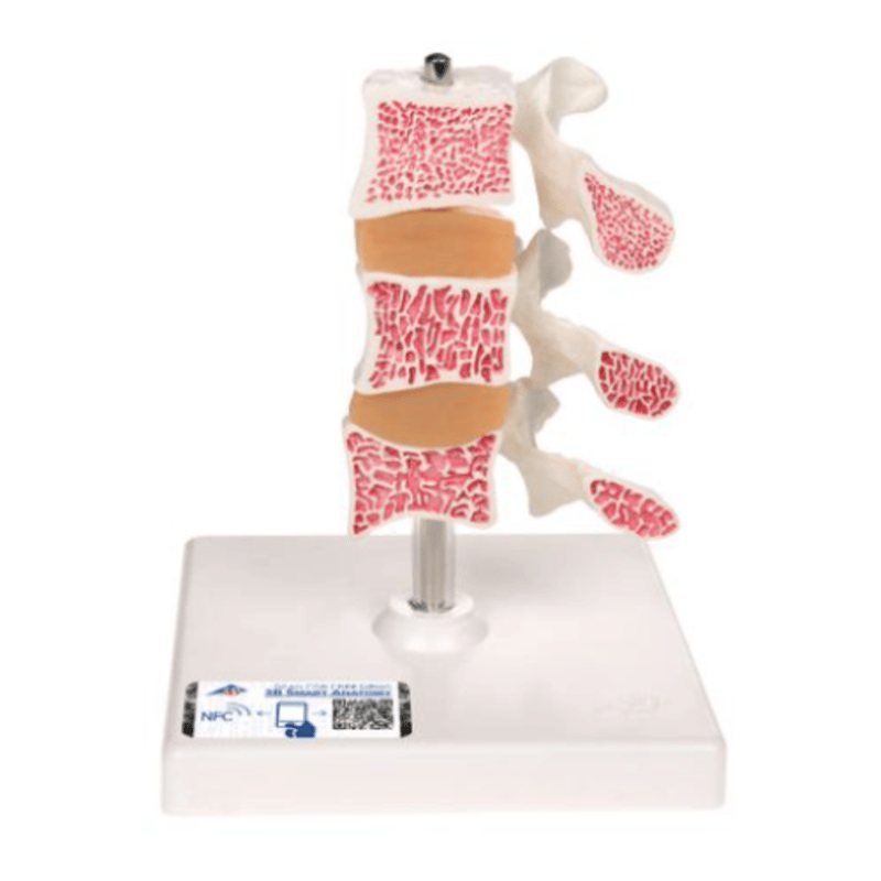 Deluxe Osteoporosis Spine Anatomy Model | Health and Care