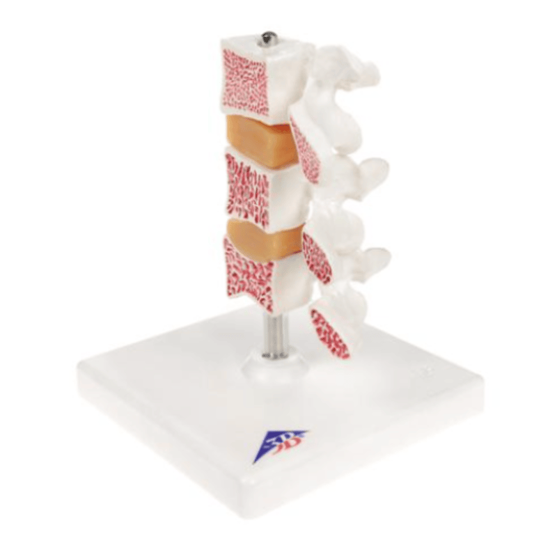 Deluxe Osteoporosis Spine Anatomy Model | Health and Care