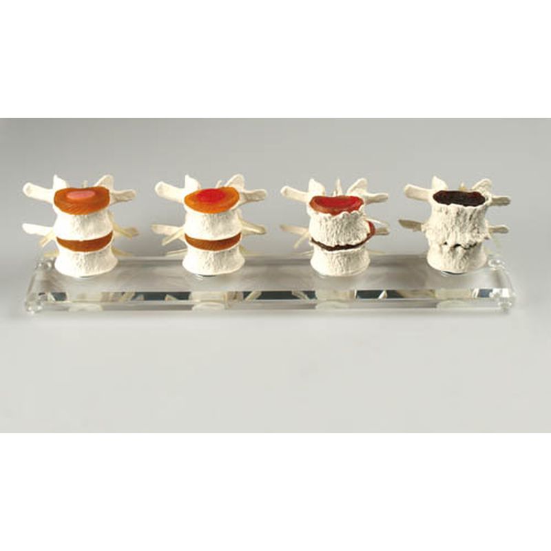 Spinal Disc Degeneration Model | Health and Care
