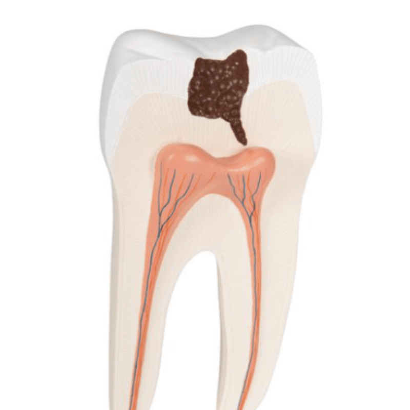 Anatomical Two-Part Human Molar Model | Health and Care
