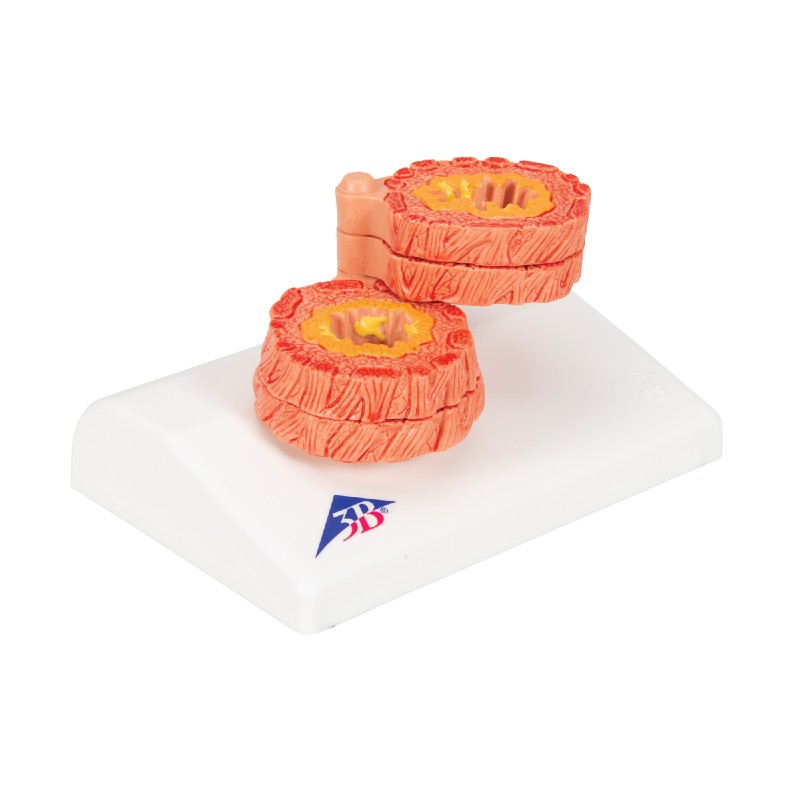 Bronchial Tissue With COPD Model | Health and Care