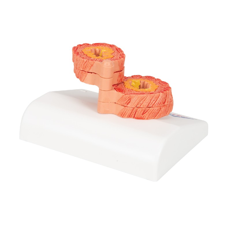 Bronchial Tissue With COPD Model | Health and Care