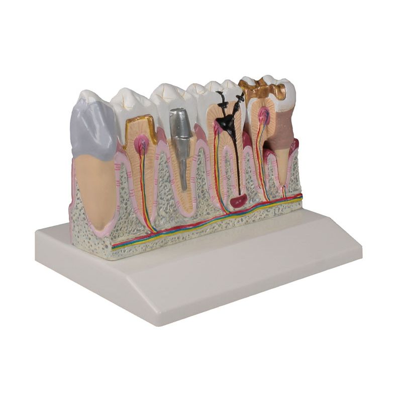 Enlarged Dental Model | Health and Care