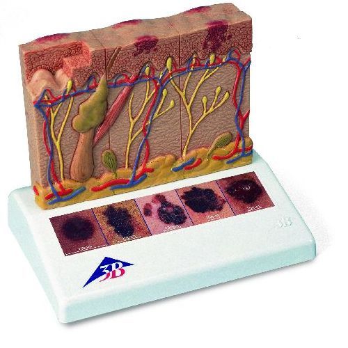 Skin Cancer Model | Health and Care