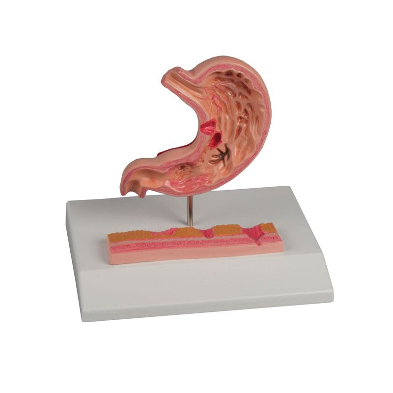 Stomach Ulcer Model | Health and Care