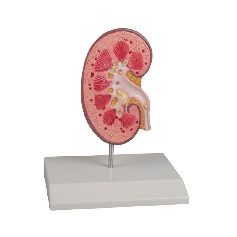 Kidney Stone Model | Health and Care