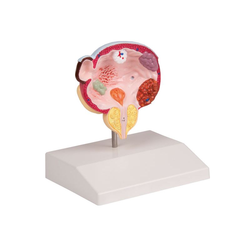 Bladder and Prostate Disease Model | Health and Care