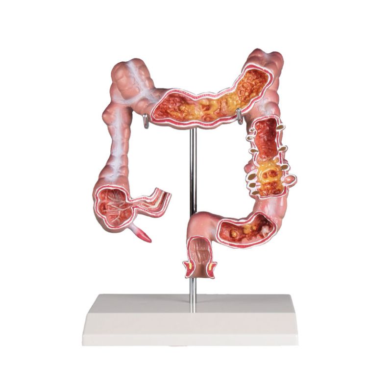 Colon Diseases Model | Health and Care