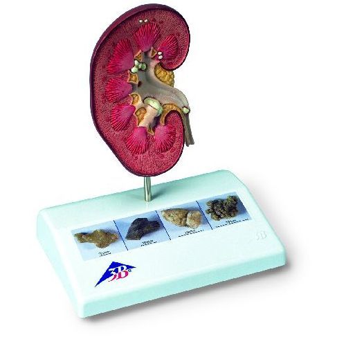 Kidney Stone Model | Health and Care