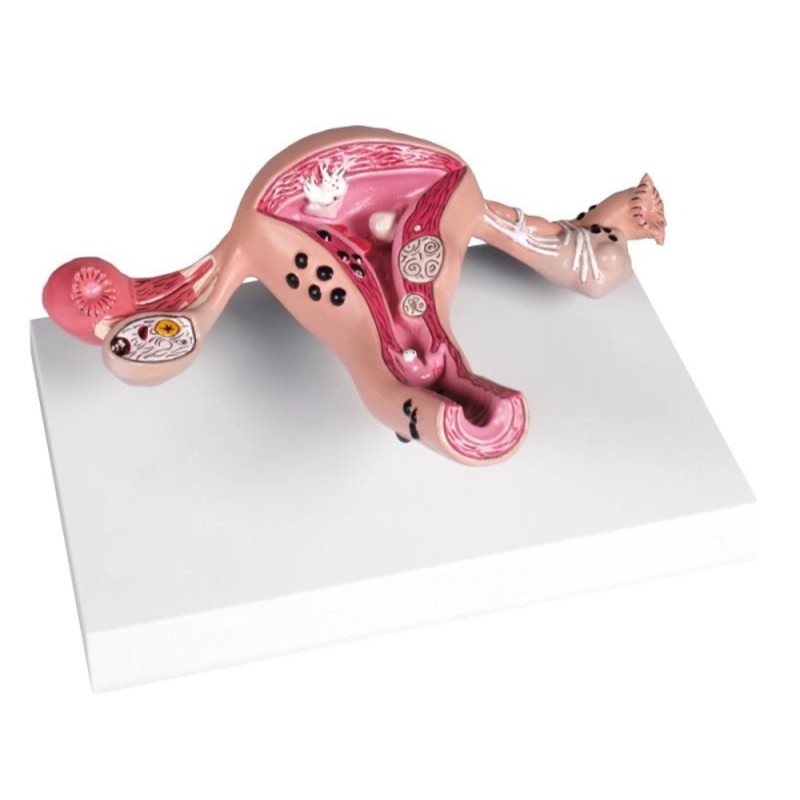 Diseases Uterus Model | Health and Care