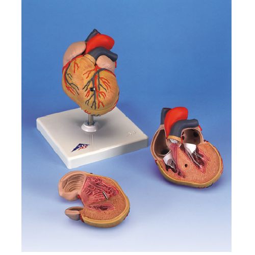 Classic Heart With Left Ventricular Hypertrophy Lvh 2 Part | Health and ...