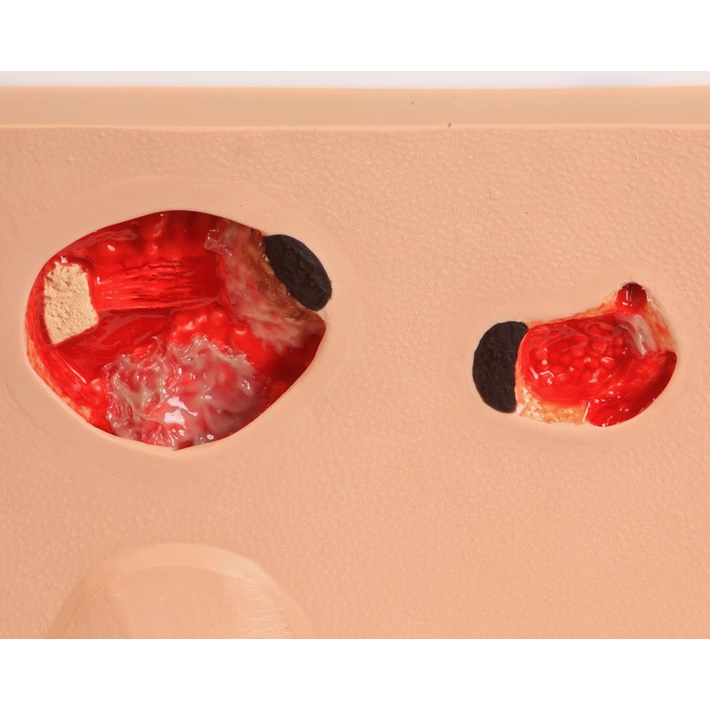 Pat Pressure Ulcer Staging Model | Health and Care