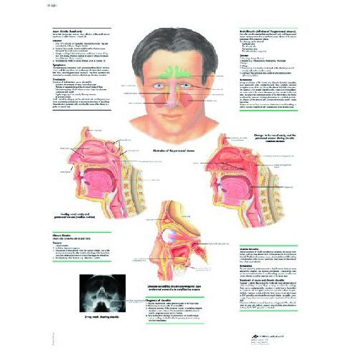 Rhinitis And Sinusitis Chart | Health and Care
