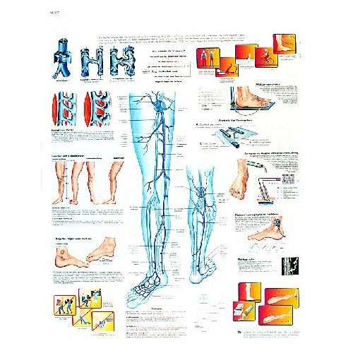 Varicose Veins Chart | Health and Care