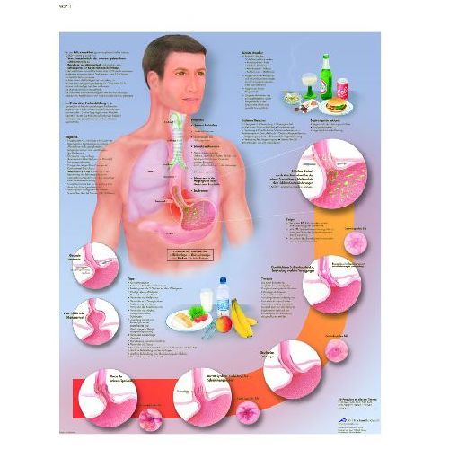 Gastroesophageal Reflux Disease Chart Gerd | Health and Care