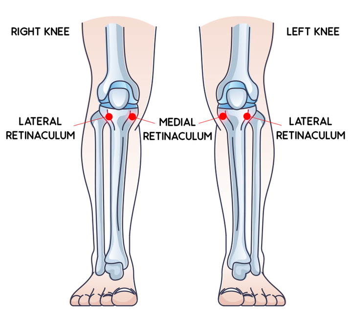 Donjoy OA Nano Unloader OA Knee Brace | Health and Care