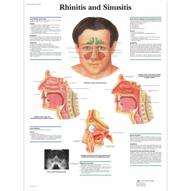 Jangan Sampai Salah Ini Perbedaan Rhinitis Dan Sinusitis Hot Sex Picture