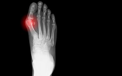 Hallux Valgus Correction Splint | Health and Care