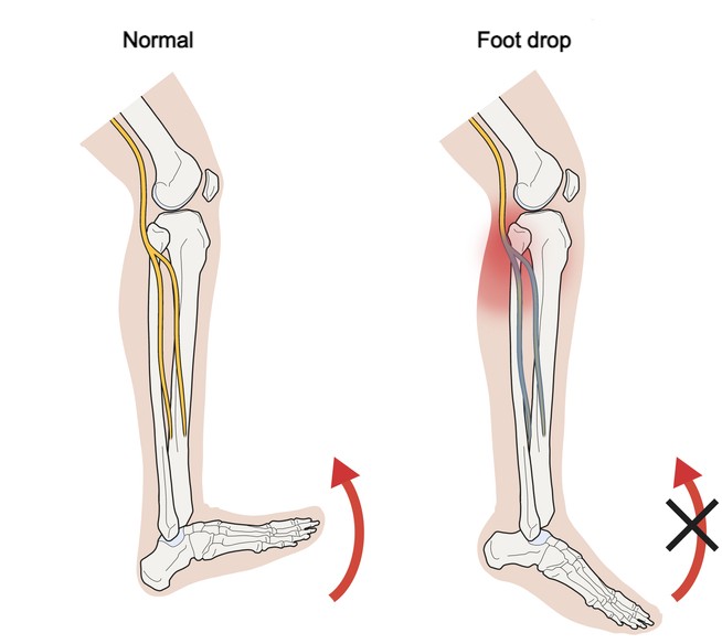 Ossur Rebound Foot-Up AFO Foot Drop Brace | Health and Care