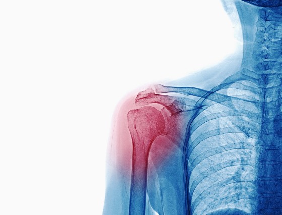 Subluxation Shoulder Brace | Health and Care