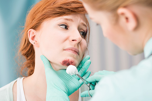 Proper Wound Care: How to Avoid Permanent Scarring | Health and Care